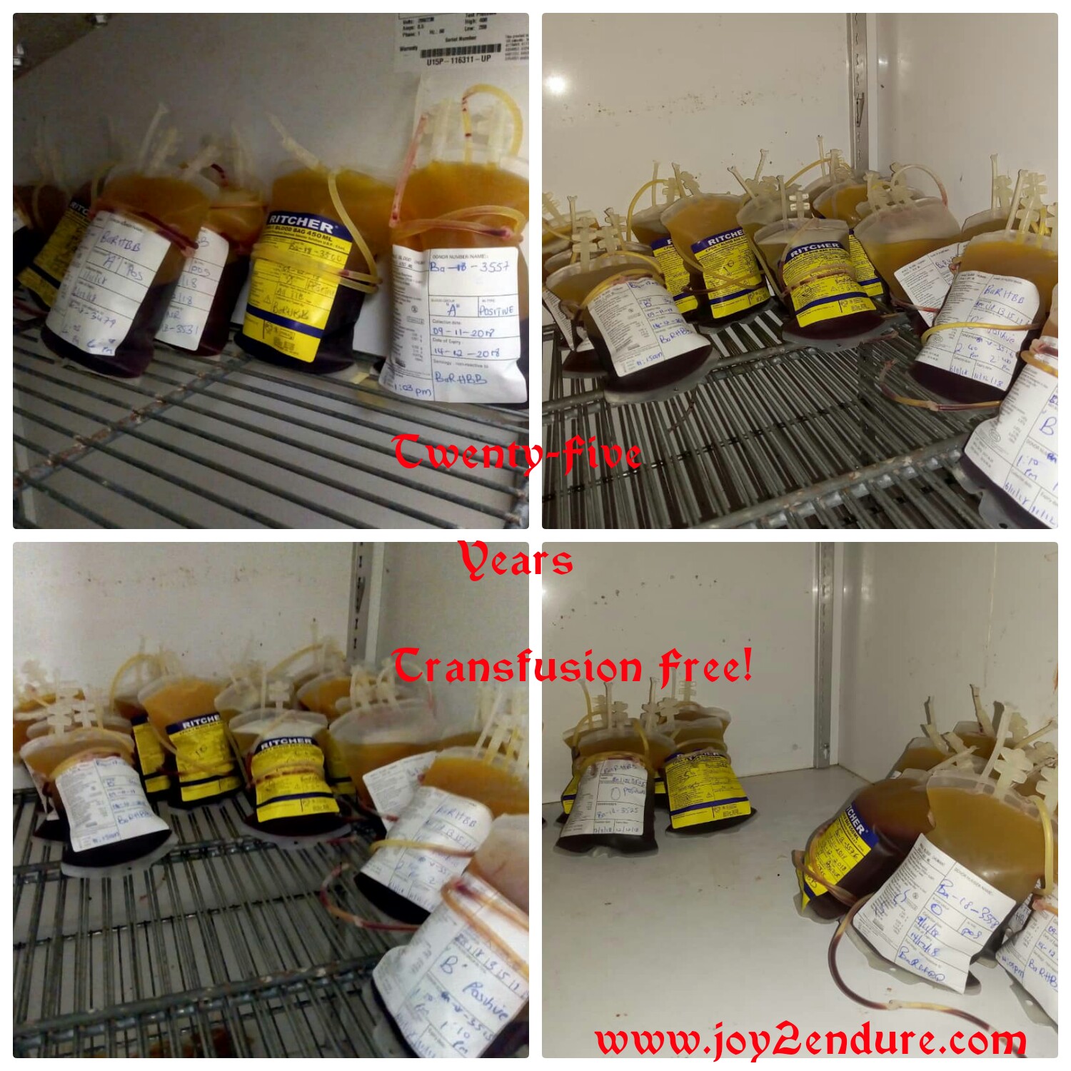 My Sickle Cell Journey: Twenty Five Years Transfusion Free and Counting ...
