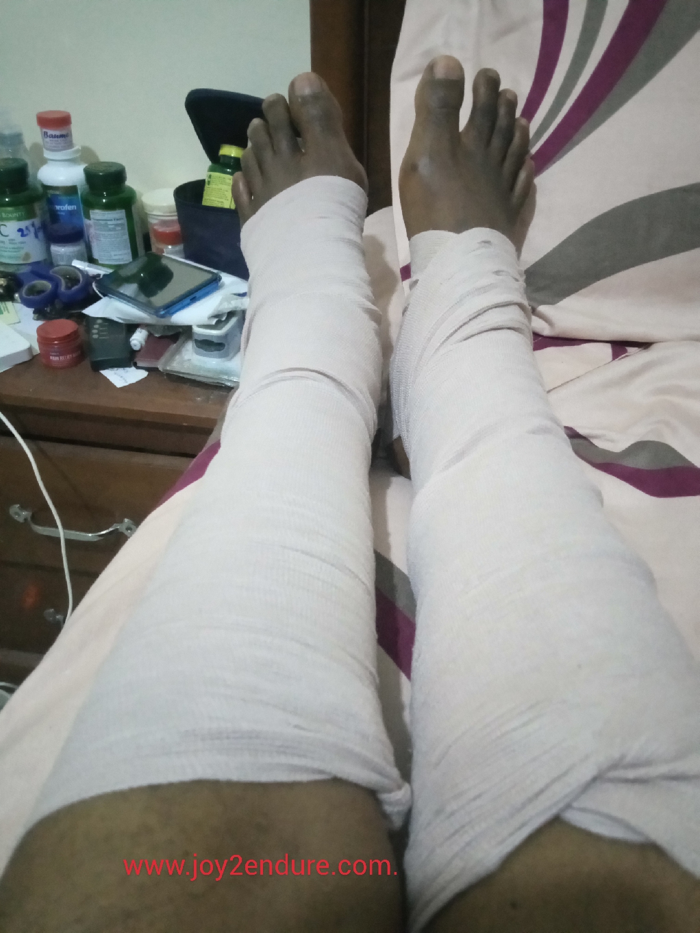 LEG ULCERATION IN SICKLE CELL: What We Need To Know. – Joy2Endure